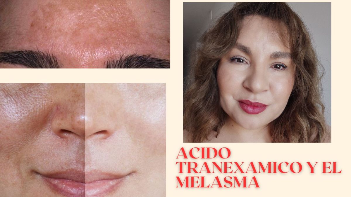 Cómo tratar el melasma: causas y soluciones efectivas – TITA EVE ESTÉTICA A TU ALCANCE