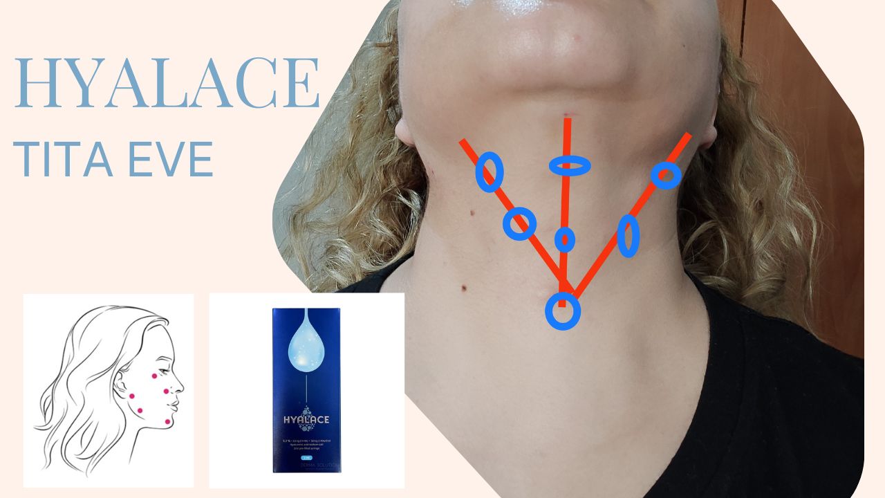 Hyalace: Un Tratamiento Antiedad con Ácido Hialurónico – TITA EVE ...